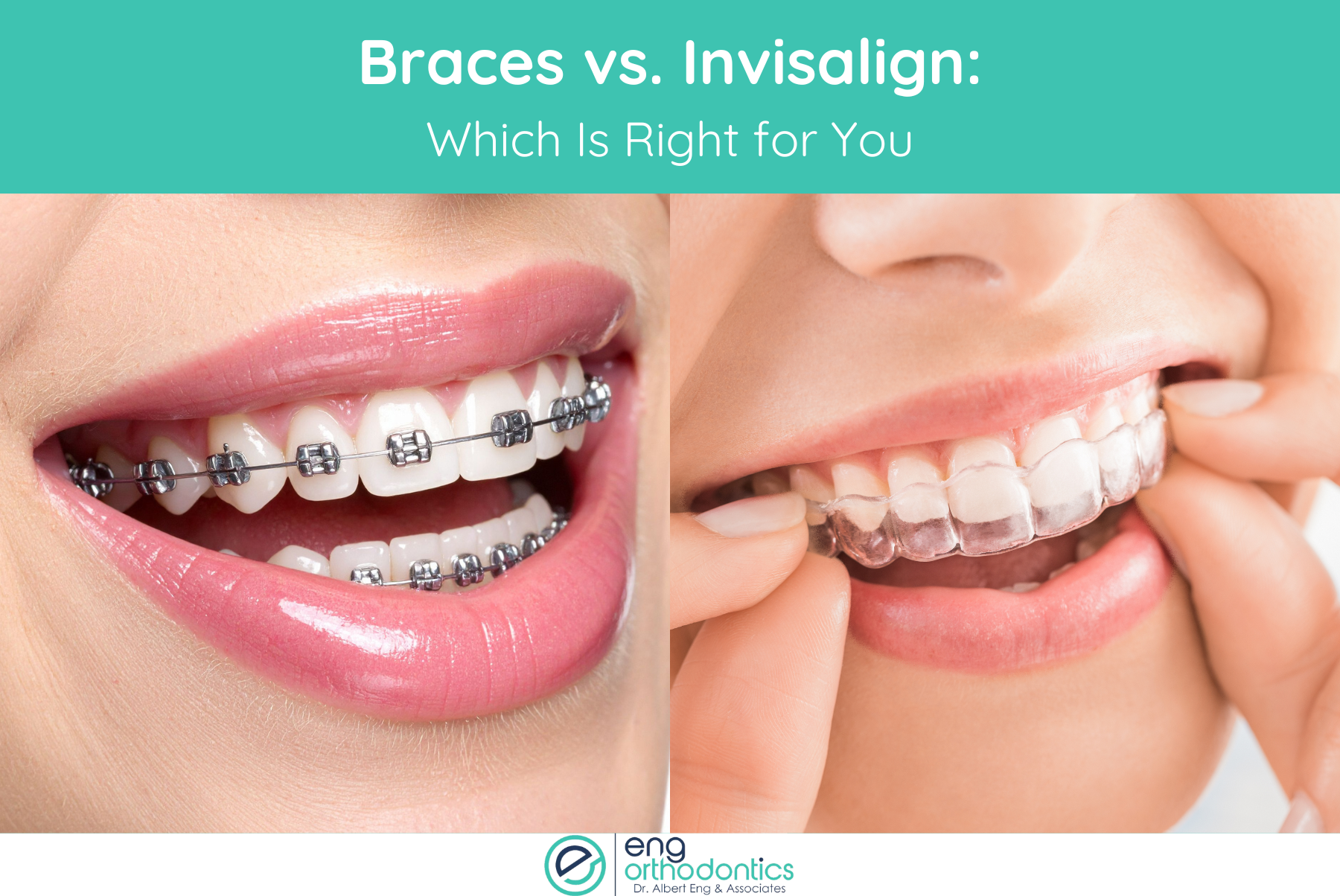 Braces vs. Invisalign: Which Is Right for You? | Eng Orthodontics